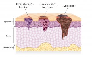 Zdravljenje kožnega raka